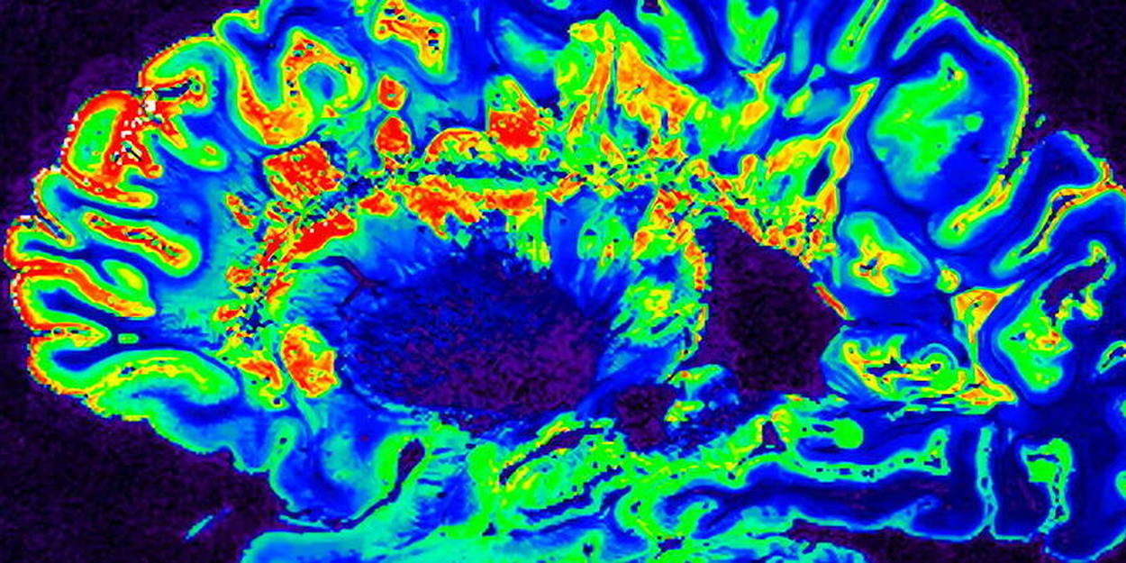 Sclérose en plaques : ce qu’il faut savoir sur cette maladie auto-immune