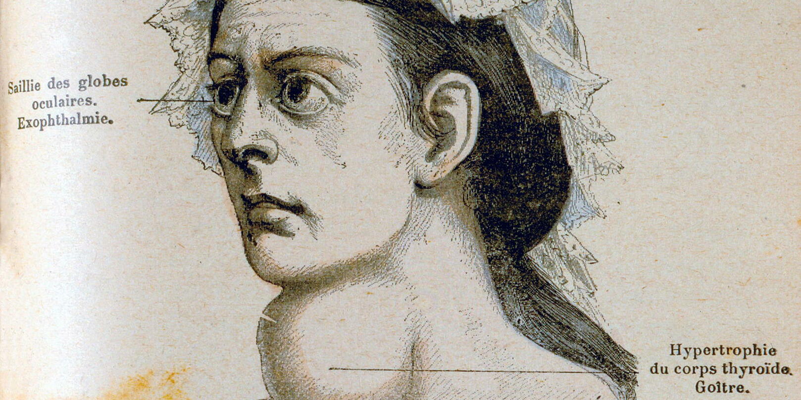 Pourquoi l’expression « crétin des Alpes » a-t-elle une origine médicale