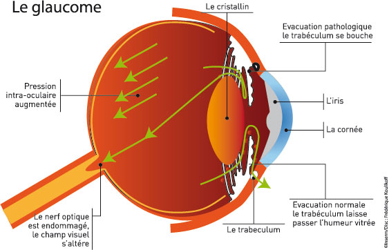 Glaucome : l'espoir d'un traitement plus efficace